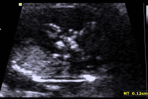Best & Affordable Ultrasound, Anomaly & NT Scans in Sharjah